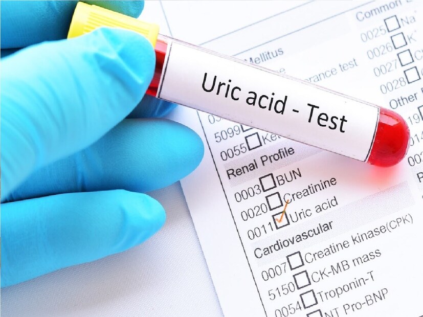 Uric Acid: యూరిక్ యాసిడ్ పెరుగుదలకు.. పాదాలలో కనిపించే ఐదు లక్షణాలు ఇవే ...
