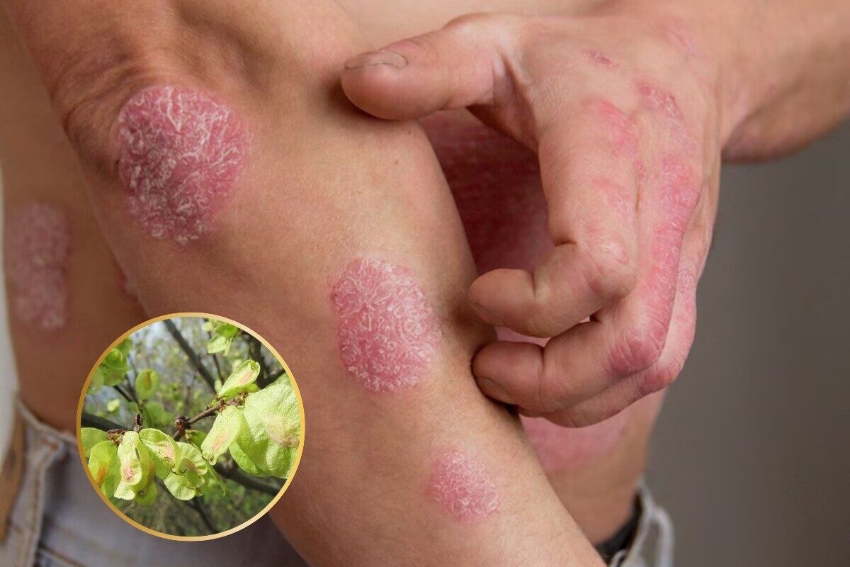 మన ఇంటి దగ్గర కనిపించే ఈ ఆకులతో.. తామర, దురద వంటి మాయదారి రోగాలు మాయం ...