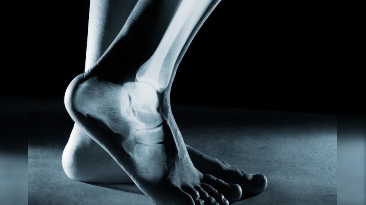 Bones Weak: ఈ వ్యాధి ఉంటే ఎముకలు సులువుగా విరుగుతాయట.. మహిళలు జాగ్రత్త పడాల్సిందే!