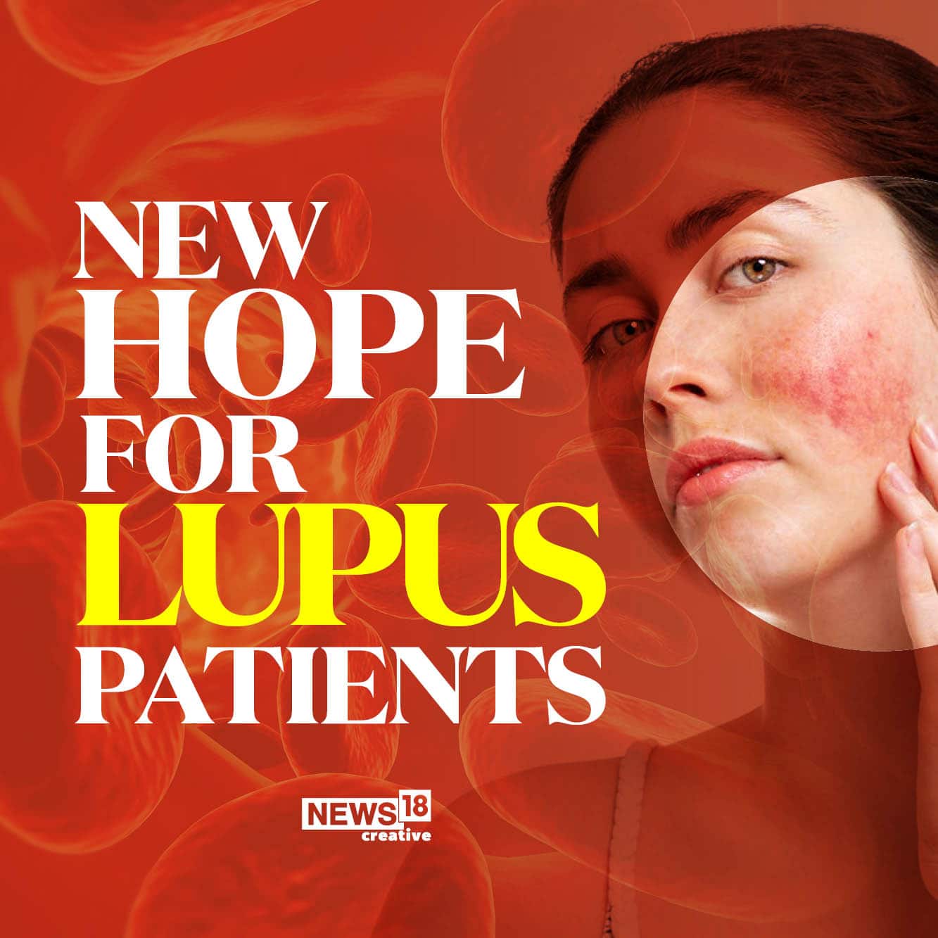 New hope for Lupus patients