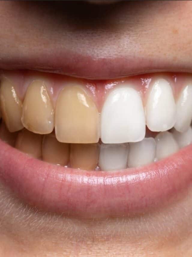 9 foods and drinks that stain teeth