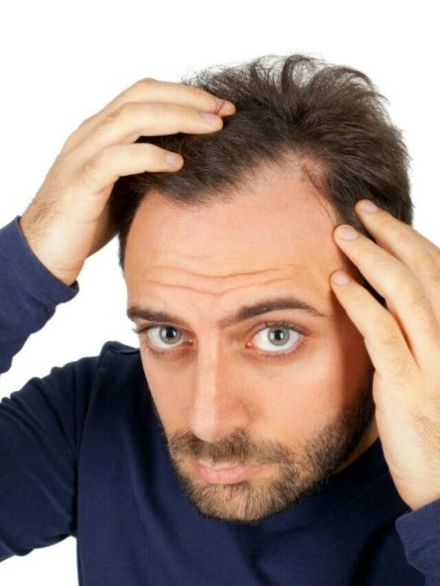 Do You Have A Receding Hairline 9 Ways To Put A Stop To It