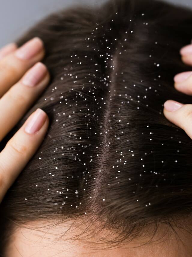 7 Ways To Reduce Dandruff