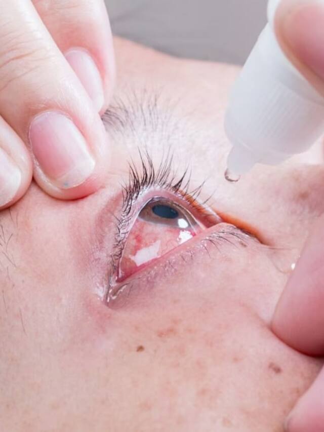 How To Use Eye Drops: آنکھوں کے قطرے کو کس طرح استعمال کریںٓ