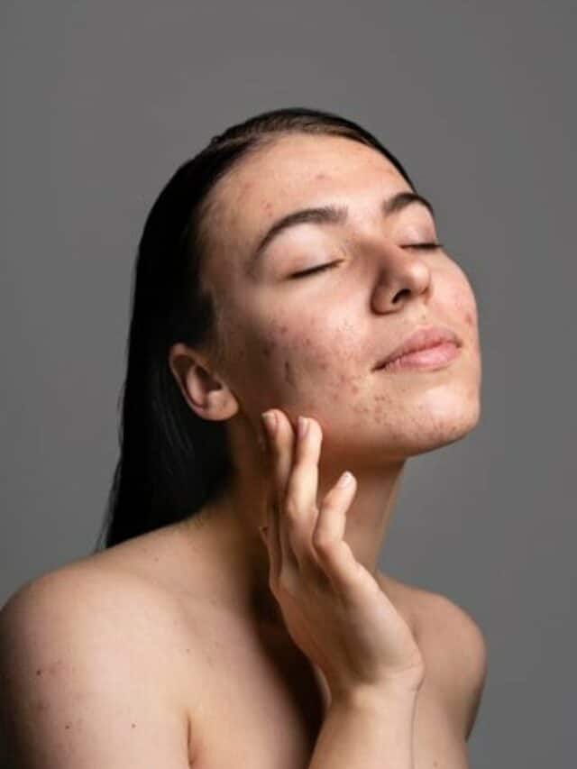 Scar Wars: 9 remedies to reduce acne marks from the face