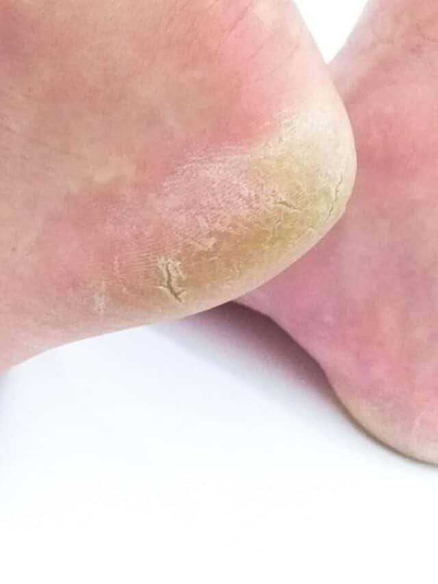 Happy Feet: Home remedies to heal your cracked heels