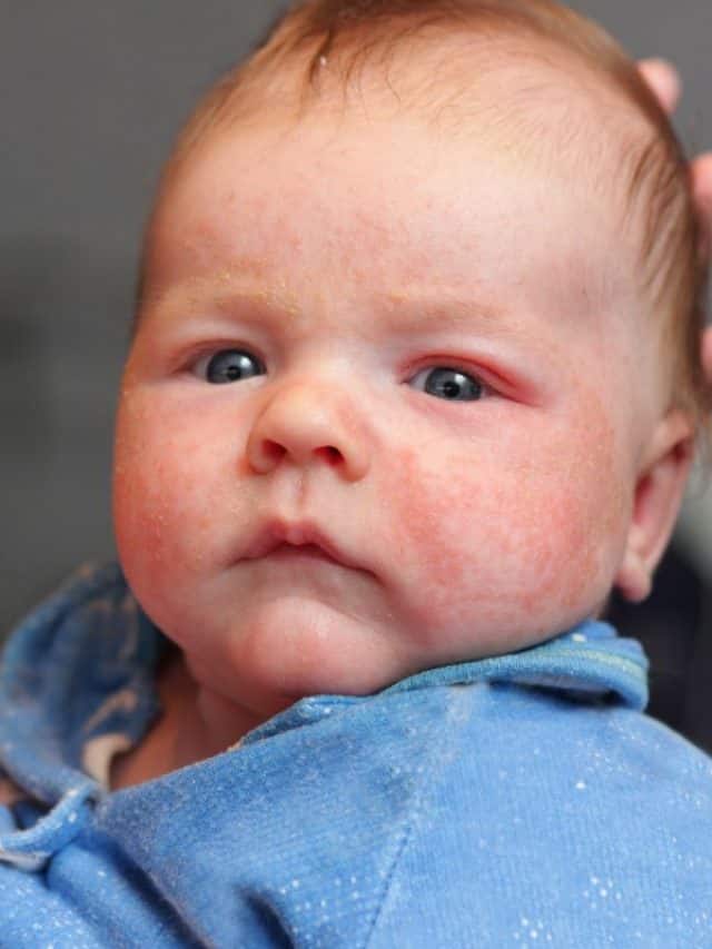 How To Manage Eczema In Children