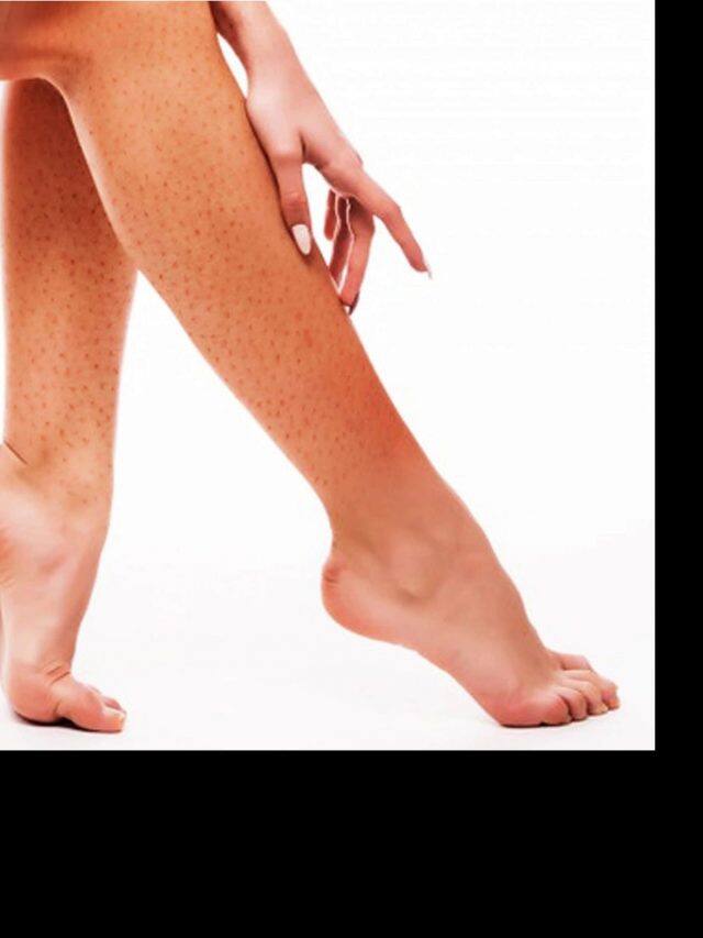 5 DIYs to Tackle Strawberry Legs