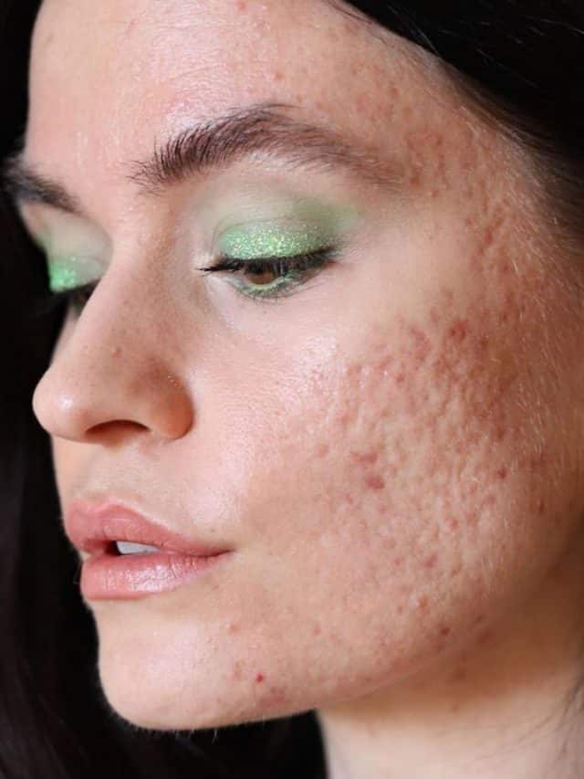 Face Lift: 9 home remedies to get rid of acne