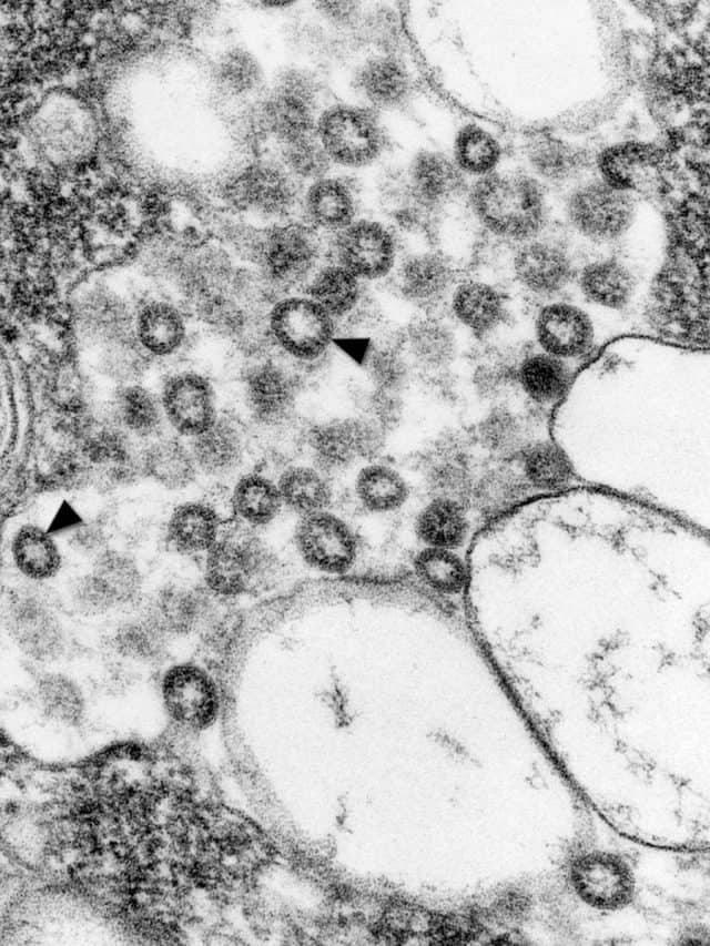 Chandipura Virus Infection: Symptoms, causes, how to protect