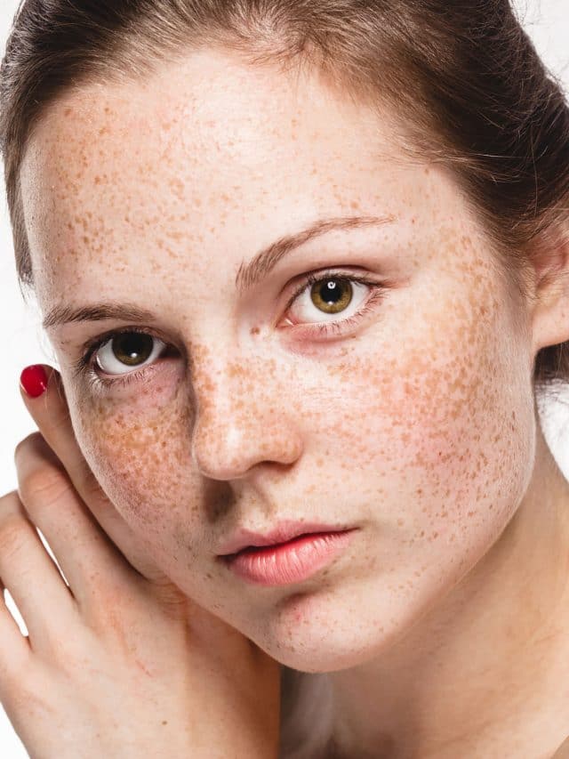 झाइयों से है परेशान तो ये घरेलू उपाय हो सकते है रामबाण