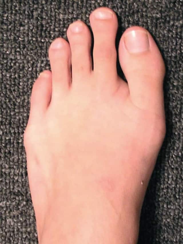 Toe Hair Loss: Could It Signal Health Issues?